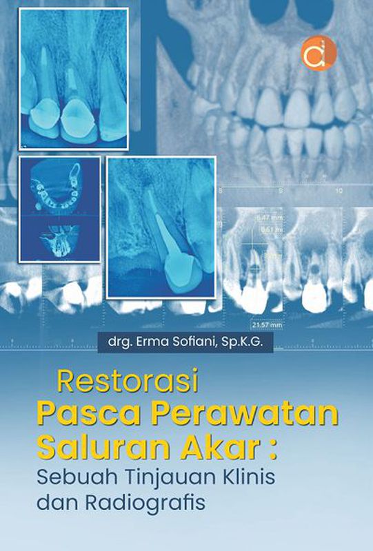 Restorasi Pasca Perawatan Saluran Akar: Sebuah Tinjauan Klinis dan ...